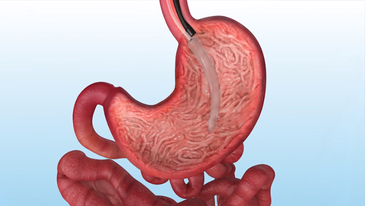 Stomach Balloon Surgery – ORBERA Procedure – Dr. Bagshahi